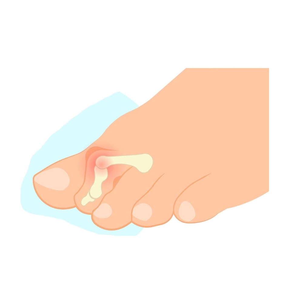 Hamertenen - Podoloog Dries De Roover