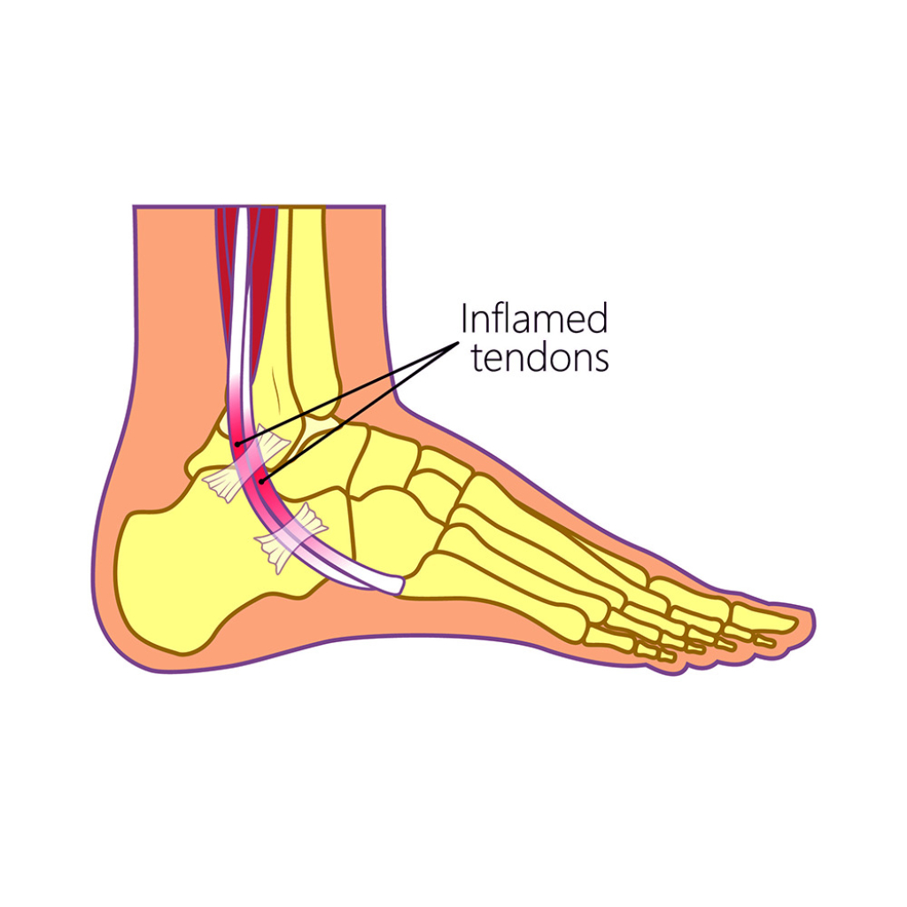 M. peroneï tendinopathie - Podoloog Dries De Roover